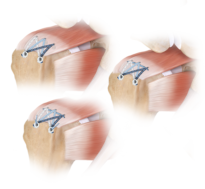 Arthrex FiberTak SpeedBridge Rotator Cuff Repair
